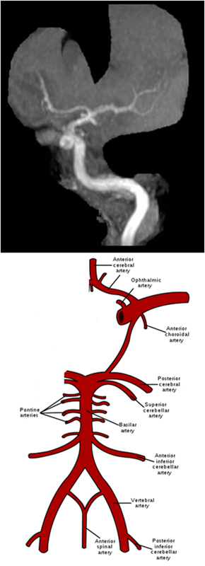 MR Brain MRA WO or WWO Neuro Protocol | OHSU